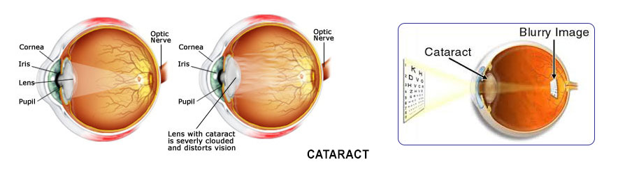 Eyecare Products | Leading Eyecare Specialists in India | Sunways India ...